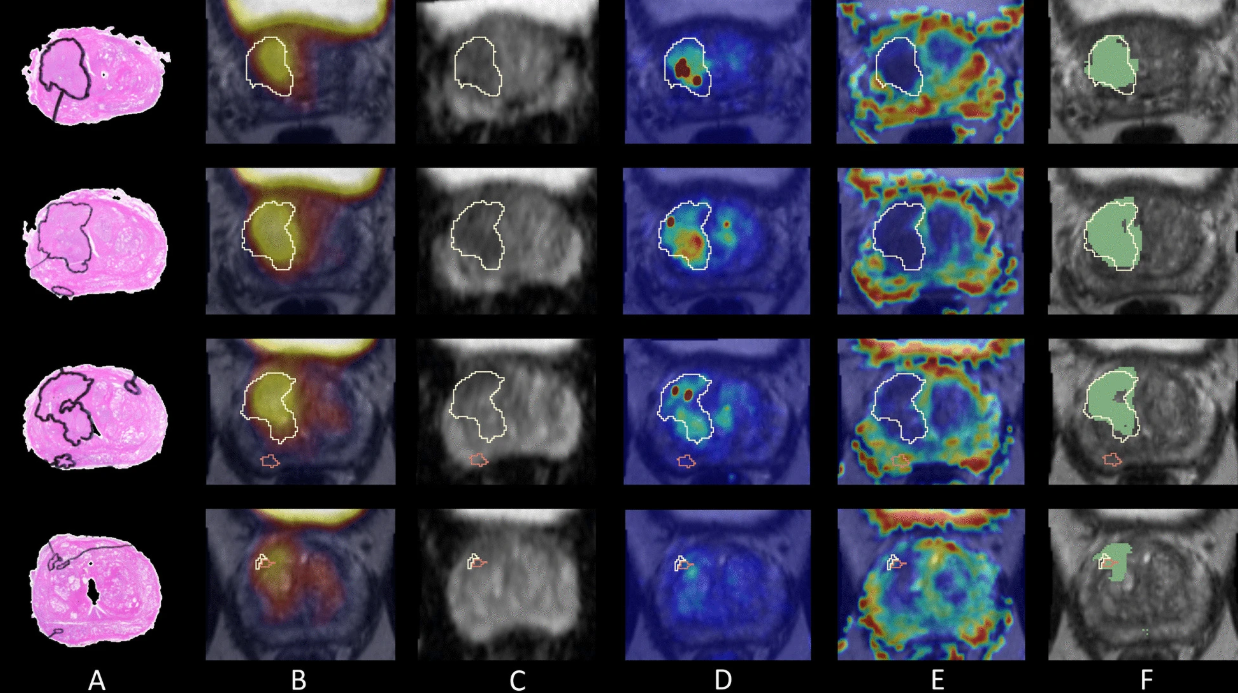 AI-Driven Radiomics for Precision Prostate Cancer Therapy | Mahyar's ...